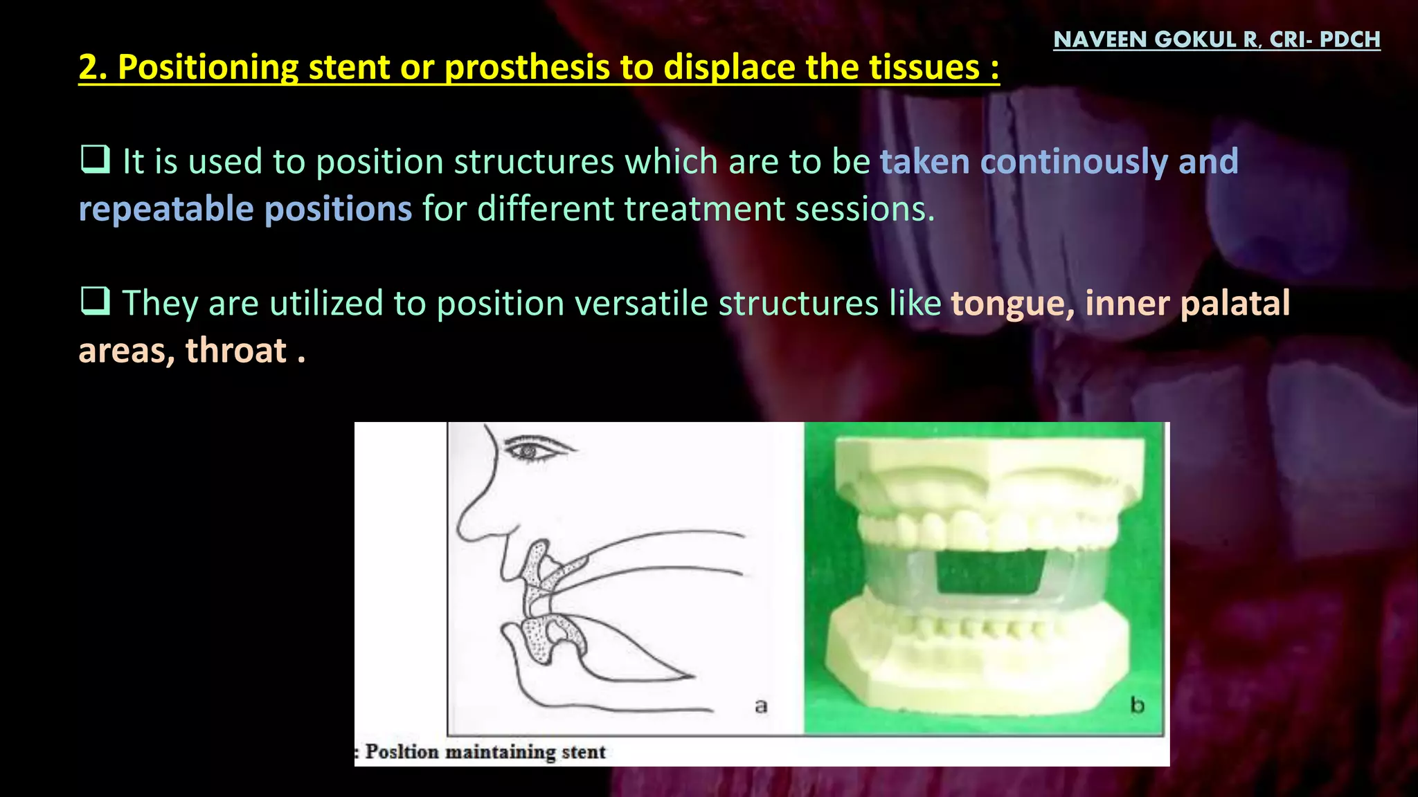 STENTS AND SPLINTS IN PROSTHODONTICS | PPTX