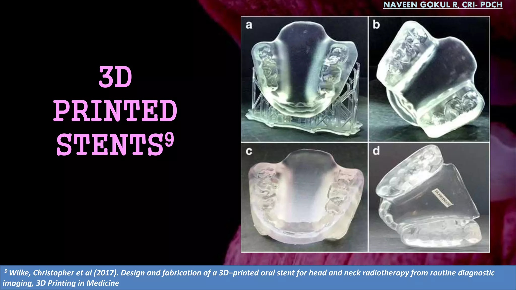 STENTS AND SPLINTS IN PROSTHODONTICS | PPTX