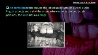 STENTS AND SPLINTS IN PROSTHODONTICS | PPTX