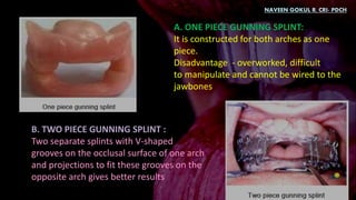 STENTS AND SPLINTS IN PROSTHODONTICS | PPTX