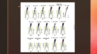 Step-back technique of root canal preparation.pptx