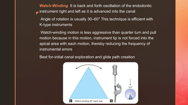 Step-back technique of root canal preparation.pptx