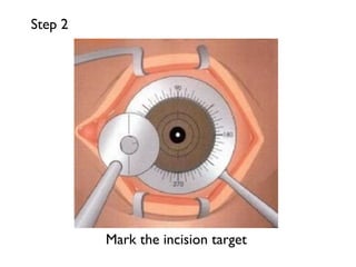 ICRS Ferrara Ring | KEY