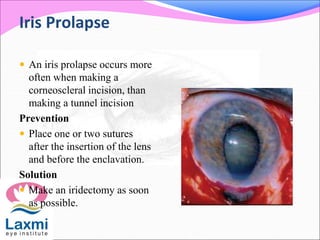 Step by step IRIS clip | PPT