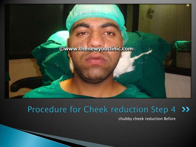 Cosmetic Surgery of Cheek in Bangalore | PPT