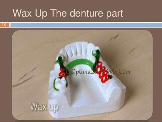 Removeable Partial Denture Steps cobalt chromium