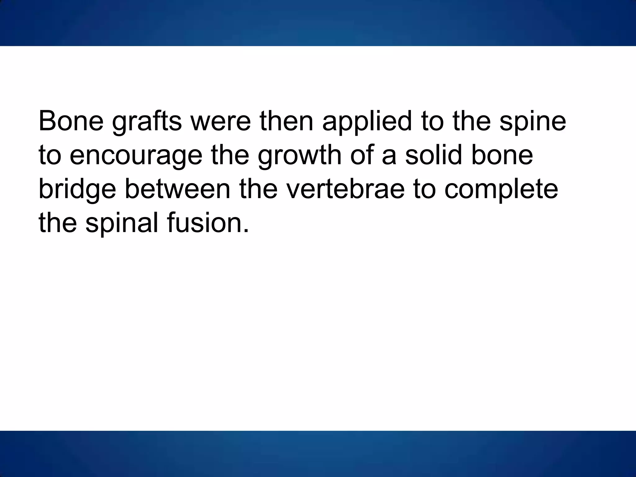 Stephanie: Severe Idiopathic Scoliosis Case Study | PPTX