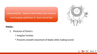 Small Incision Cataract Surgery steps.pptx