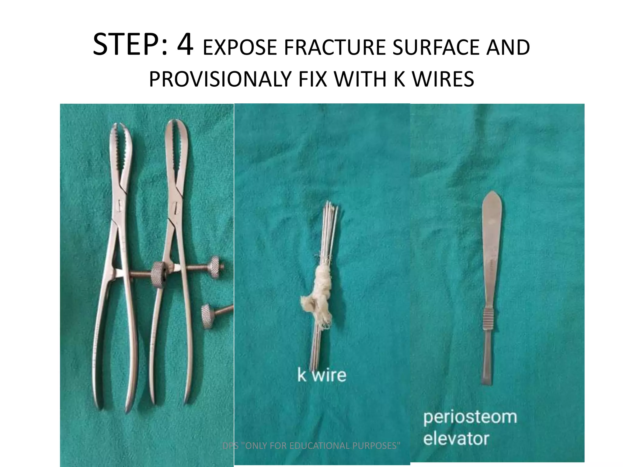 Steps for surgical managment of fracture intercondylar humerus | PPT