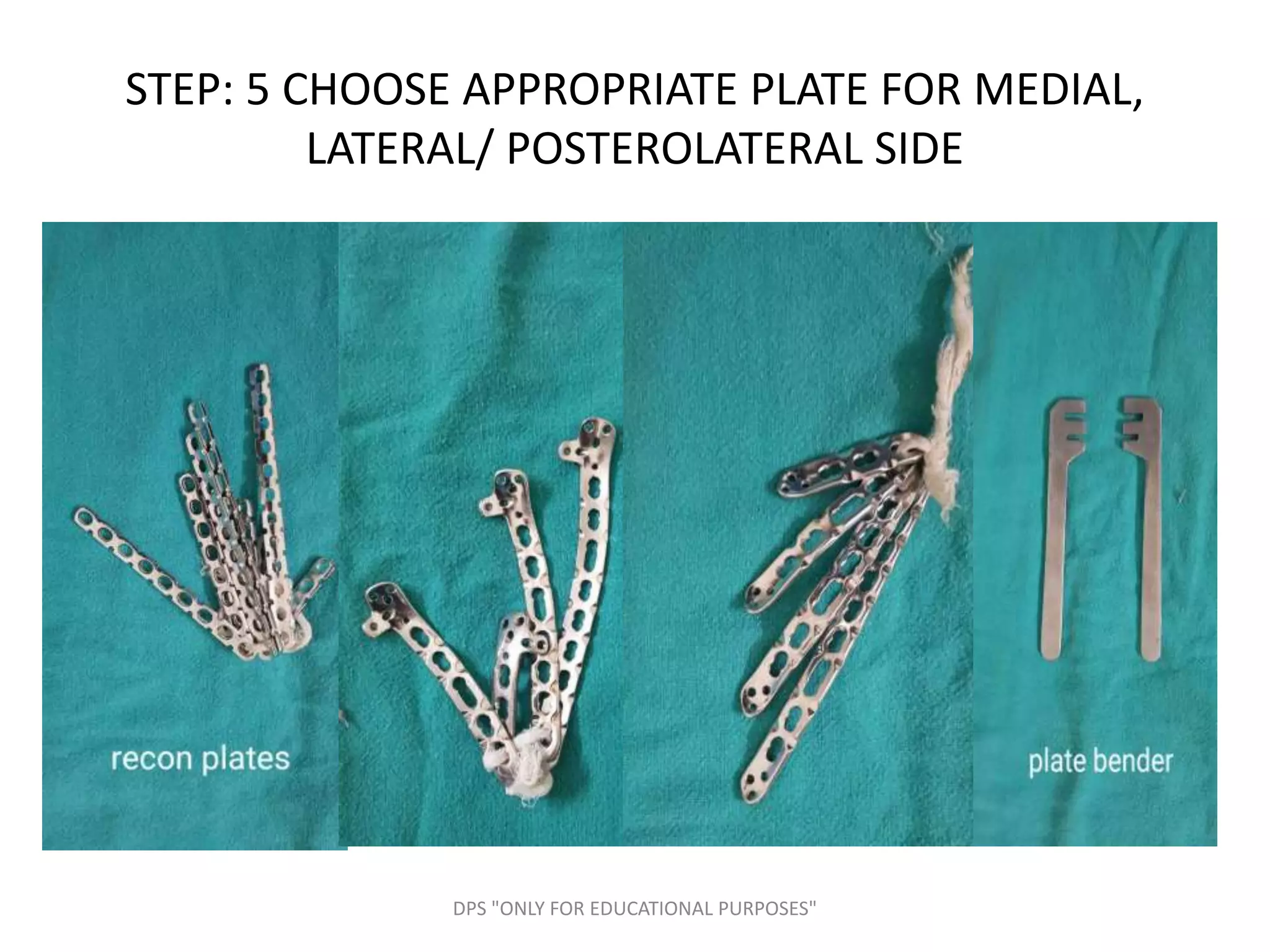 Steps for surgical managment of fracture intercondylar humerus | PPT