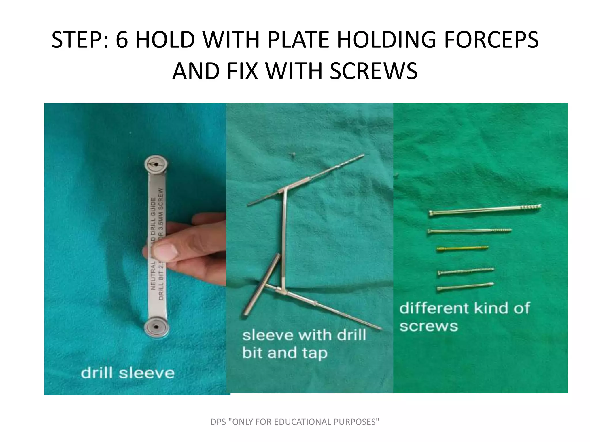 Steps for surgical managment of fracture intercondylar humerus | PPT