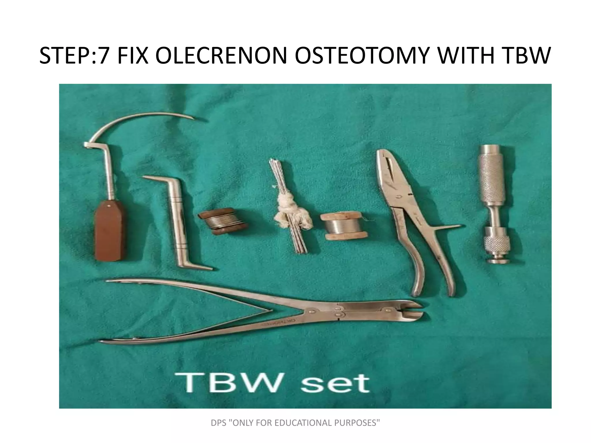 Steps for surgical managment of fracture intercondylar humerus | PPT