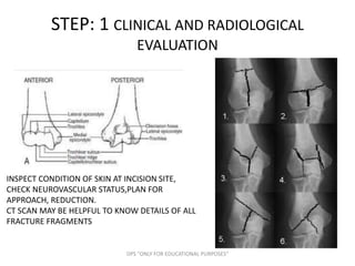 Steps for surgical managment of fracture intercondylar humerus | PPTX