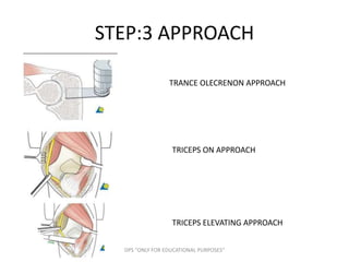 Steps for surgical managment of fracture intercondylar humerus | PPT