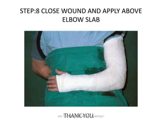 Steps for surgical managment of fracture intercondylar humerus | PPT