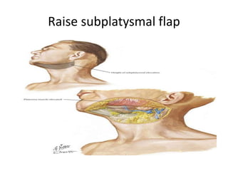 Steps in selective neck dissection | PPTX