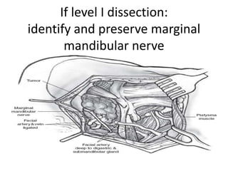 Steps in selective neck dissection | PPTX