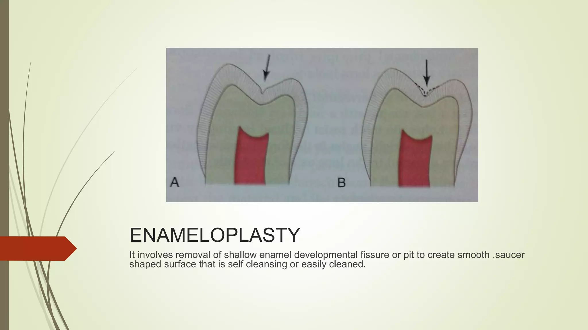 Steps of Tooth preparation (in brief) | PPTX