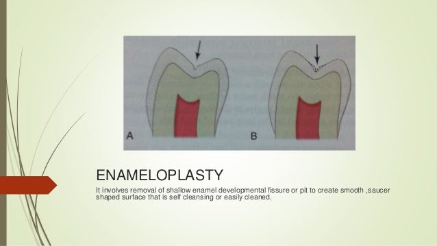 Steps of Tooth preparation (in brief)