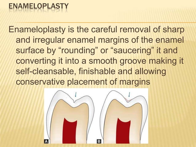 Steps Of Cavity Preparation | PPTX | Dental Health | Diseases and ...