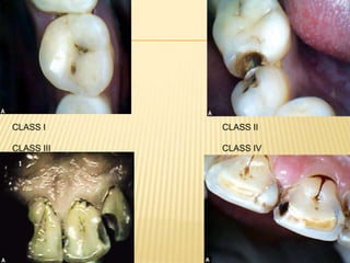 Steps Of Cavity Preparation | PPTX