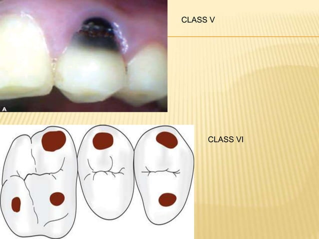 Steps Of Cavity Preparation | PPTX | Dental Health | Diseases and ...