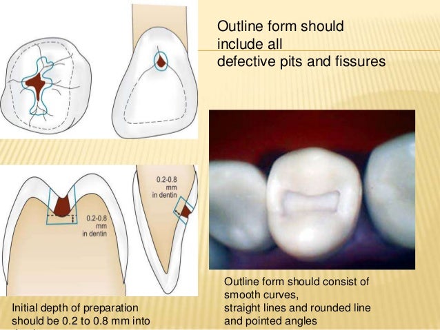 Steps Of Cavity Preparation