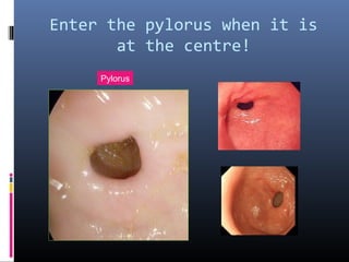Steps of diagnostic endoscopy | PPT