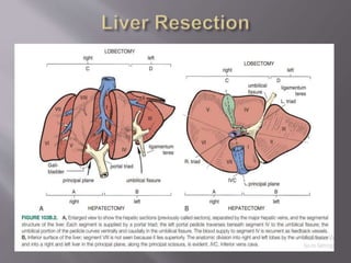 Steps of left hepatectomy.dr quiyum | PPTX