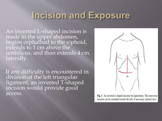 Steps of left hepatectomy.dr quiyum | PPTX