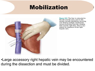 Steps of open rt hepatectomy.dr quiyum | PPTX