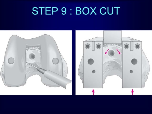 Steps total knee replacement | PPT