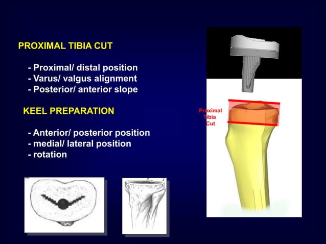 Steps total knee replacement | PPT