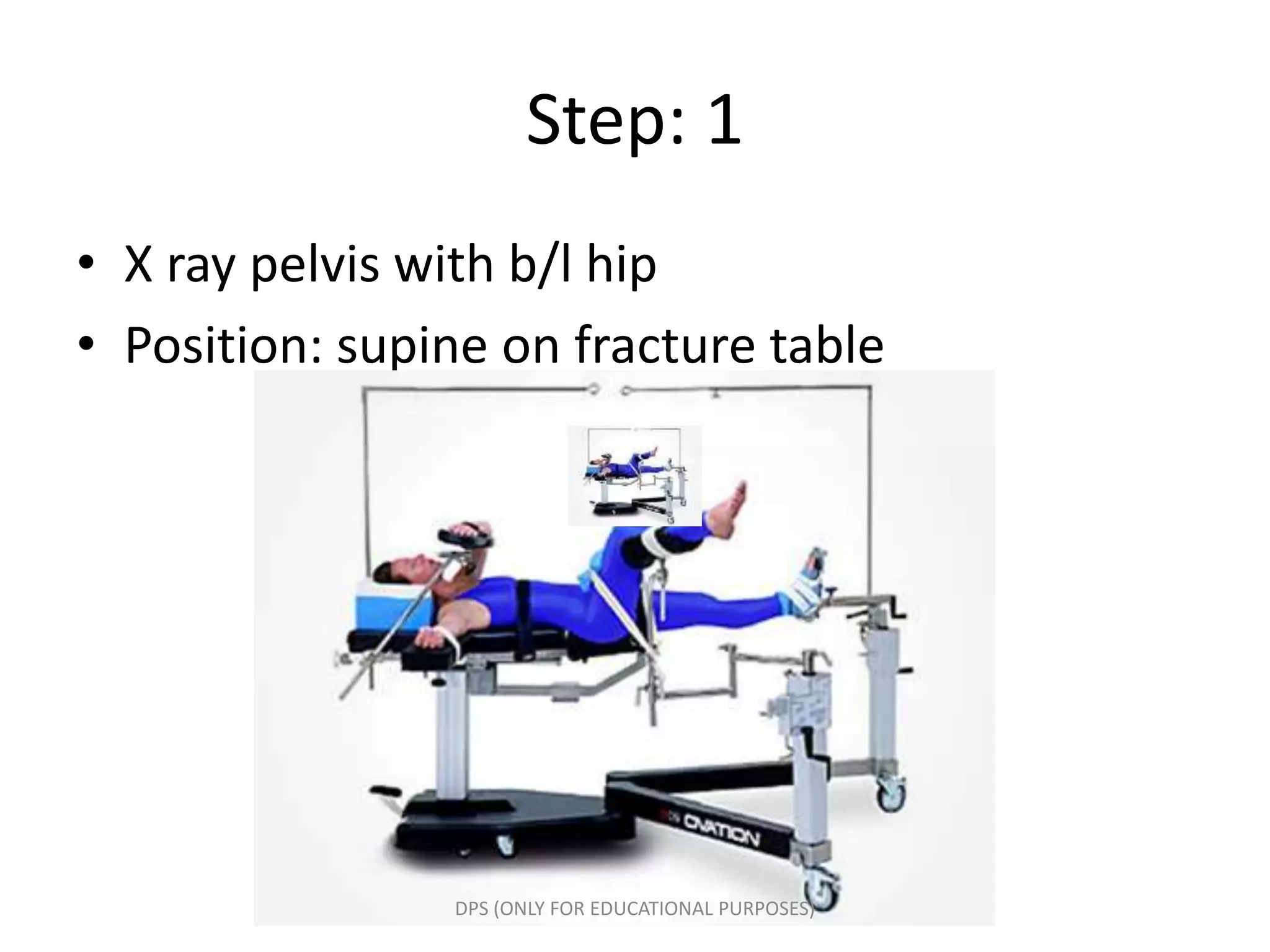 Steps to perform dynamic hip screw ( dhs) | PPTX
