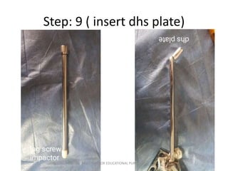 Steps to perform dynamic hip screw ( dhs) | PPTX