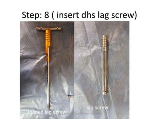 Steps to perform dynamic hip screw ( dhs) | PPTX