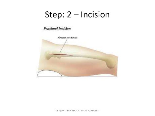 Steps To Perform Dynamic Hip Screw Dhs