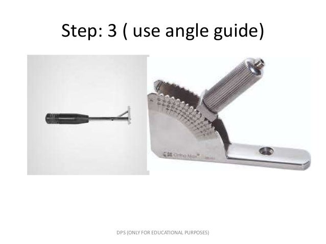 Steps To Perform Dynamic Hip Screw Dhs