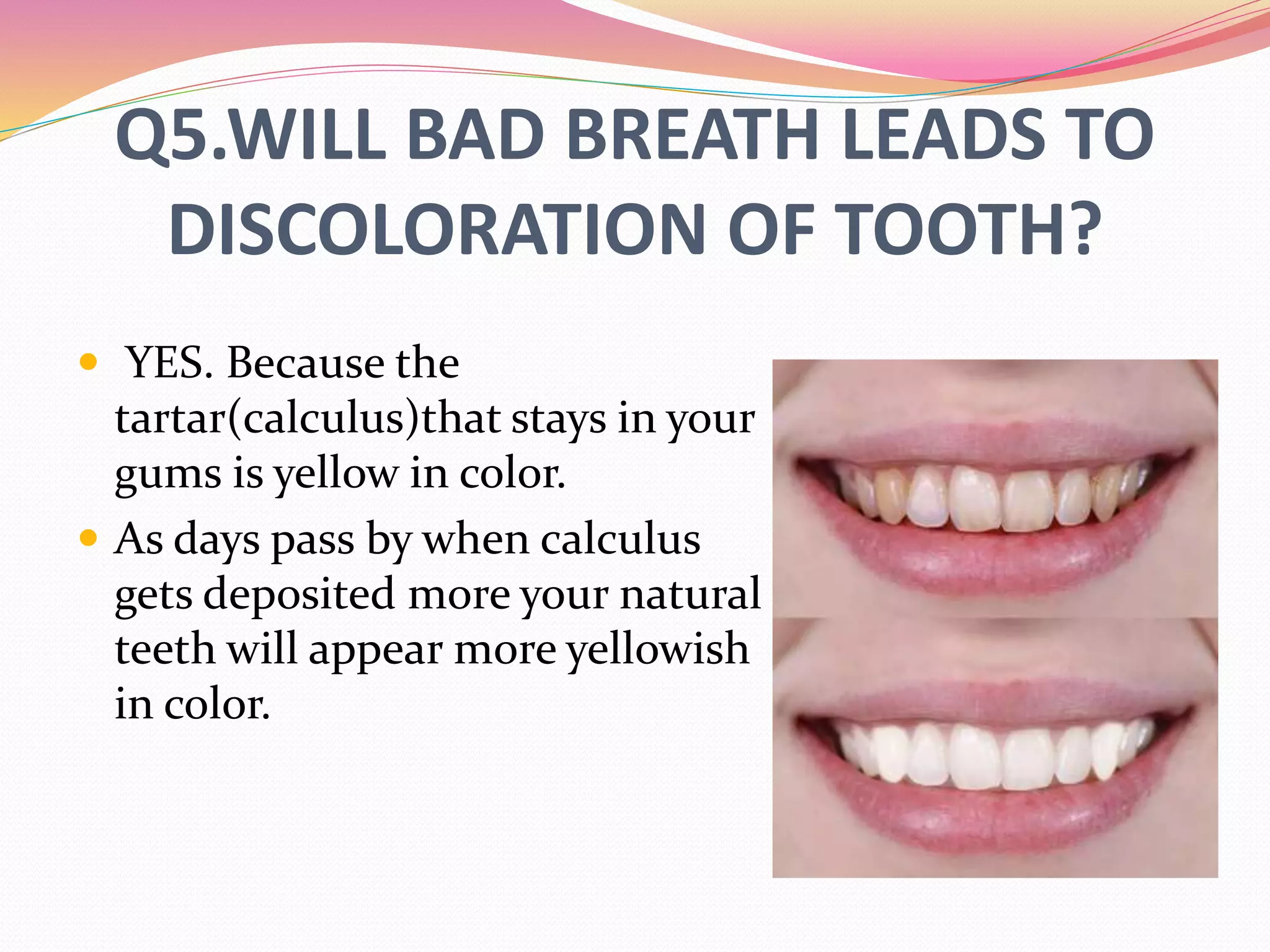 Steps to prevent bad breath | PPT