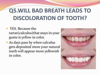 Steps to prevent bad breath | PPTX