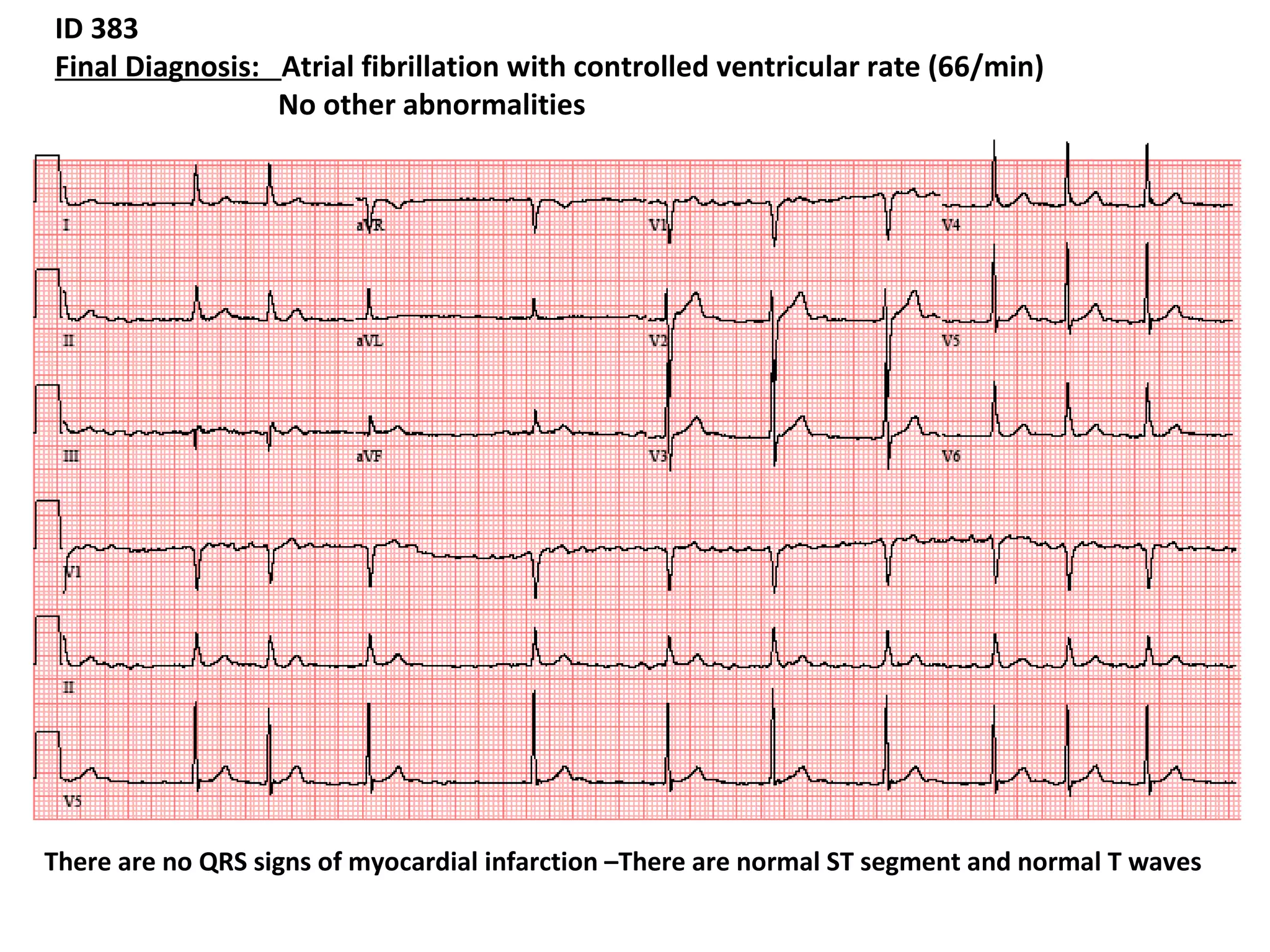 Stepwise intepretation - ECG #4 | PPT