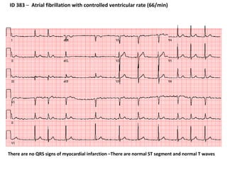 Stepwise intepretation - ECG #4 | PPT