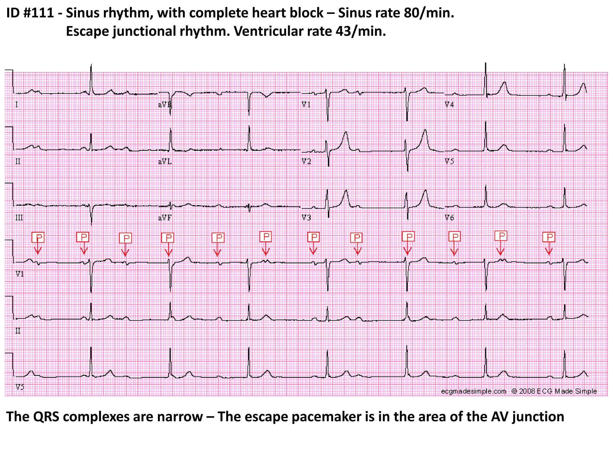 Stepwise interpretation ECG #12 | PPT Stepwise interpretation ECG #12 | PPT