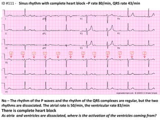 Stepwise interpretation ECG #12 | PPTX