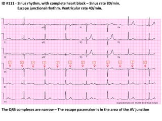 Stepwise interpretation ECG #12 | PPT
