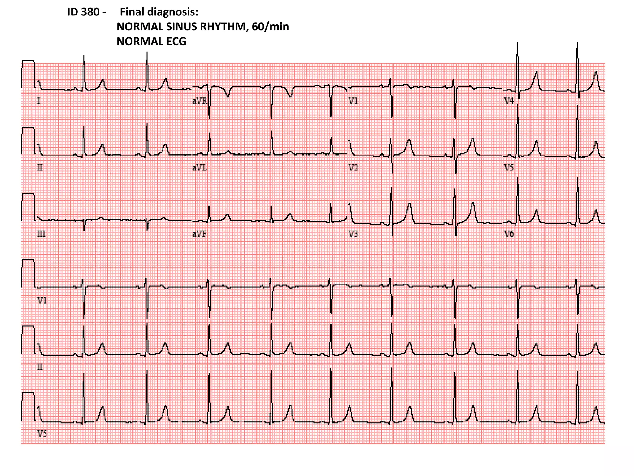 Stepwise interpretation of ECG - #01 ID 380 | PPT