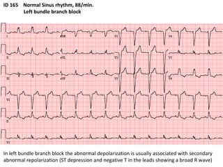 Stepwise interpretation of ECG - #05 no Dx ID175 | PPT