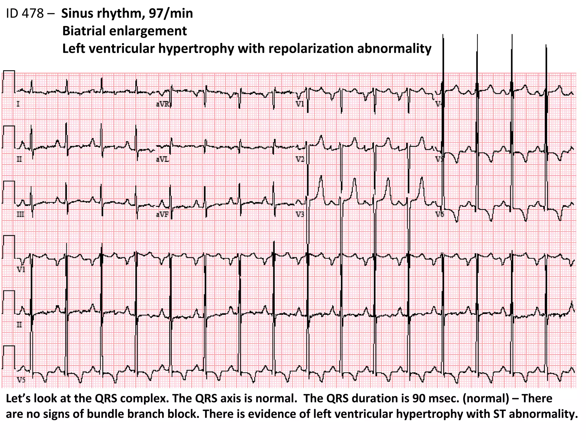 Stepwise interpretation of ECG - #08 no Dx ID478 | PPT