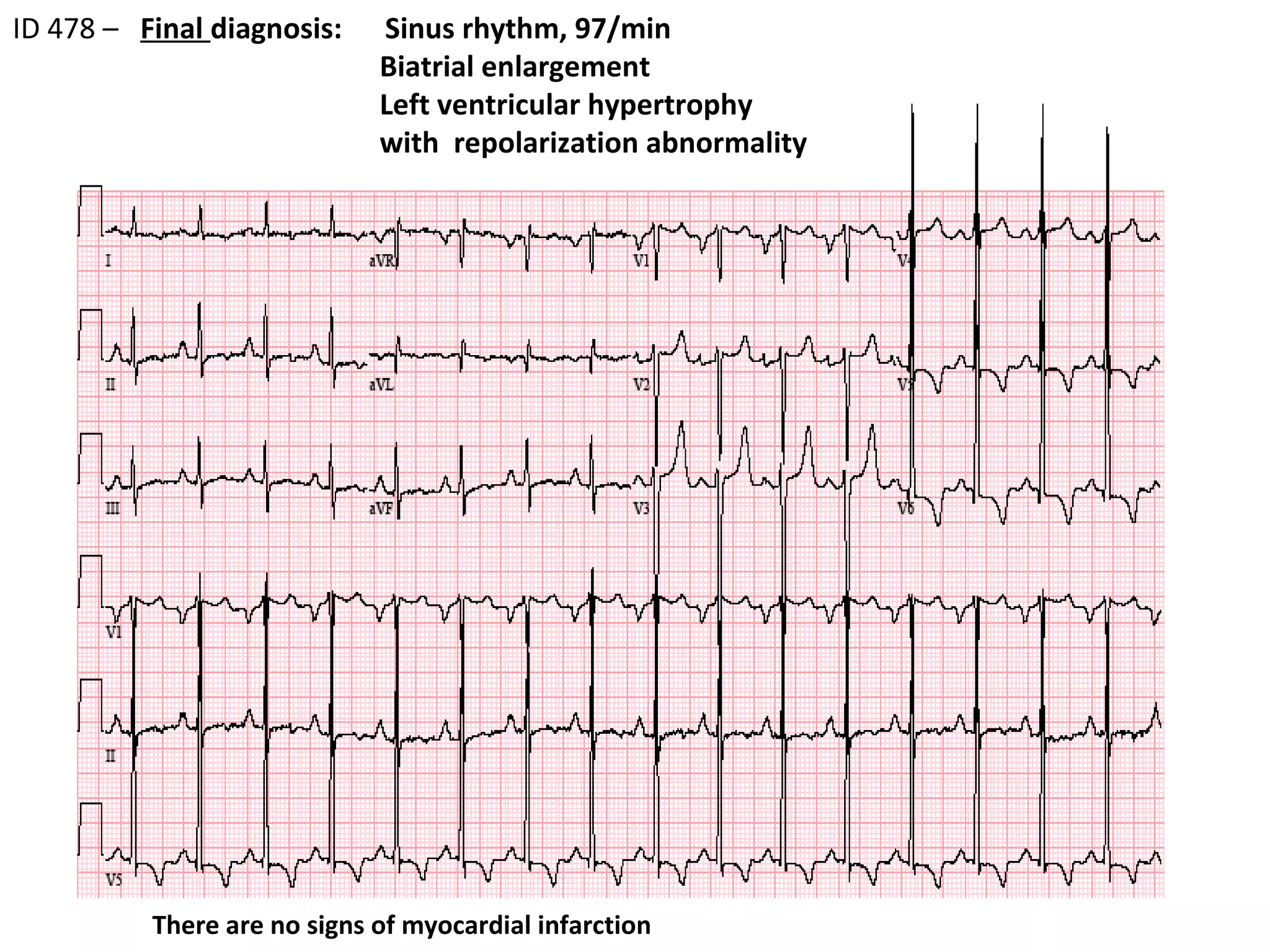 Stepwise interpretation of ECG - #08 no Dx ID478 | PPT
