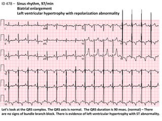 Stepwise interpretation of ECG - #08 no Dx ID478 | PPT